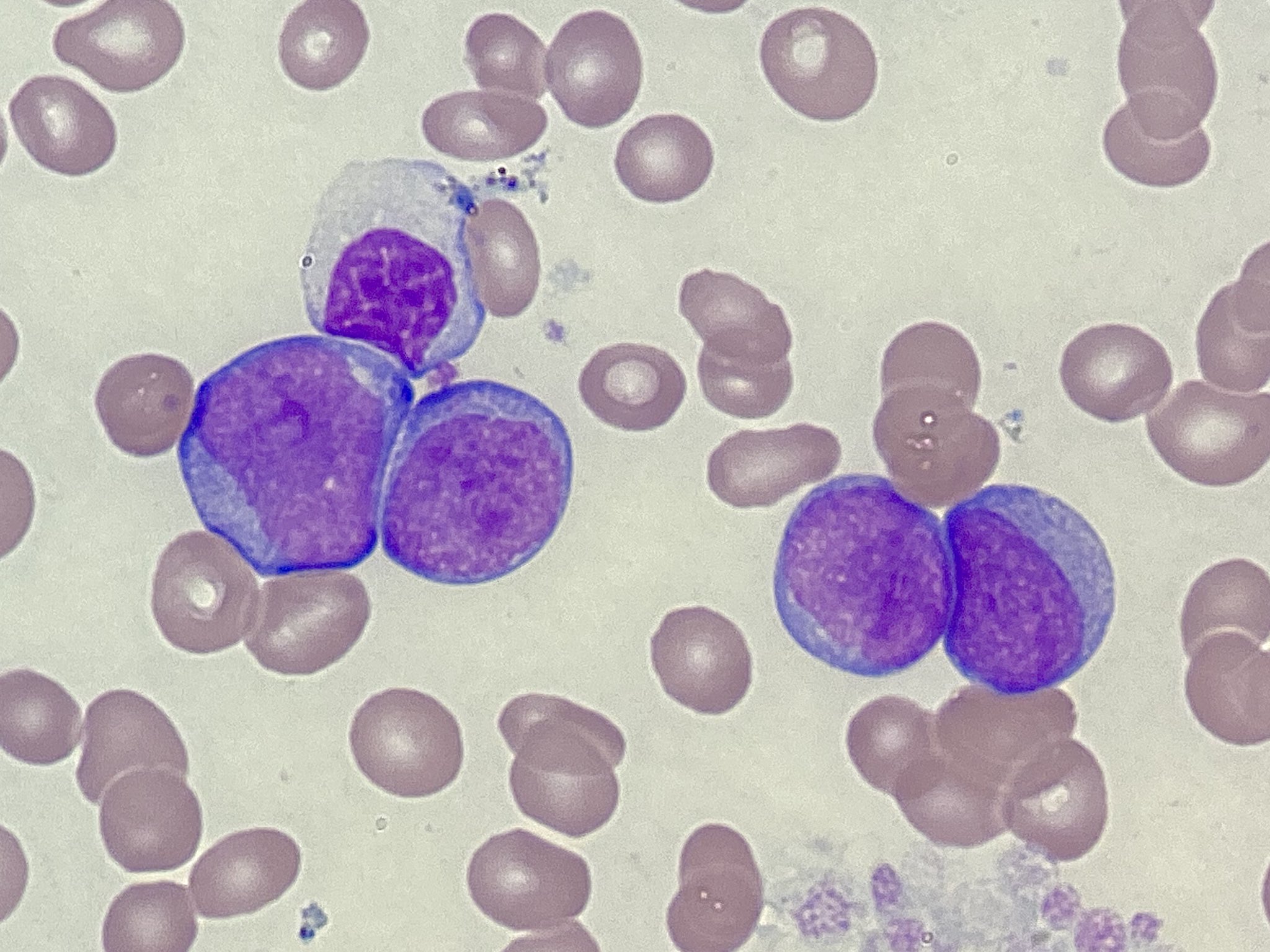 Blast Peripheral Blood