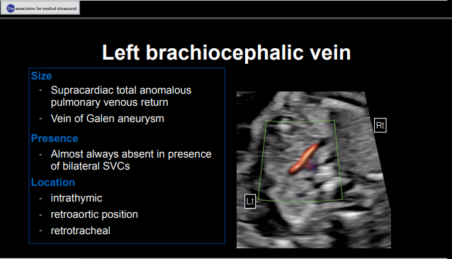 Brachiocephalic Vein