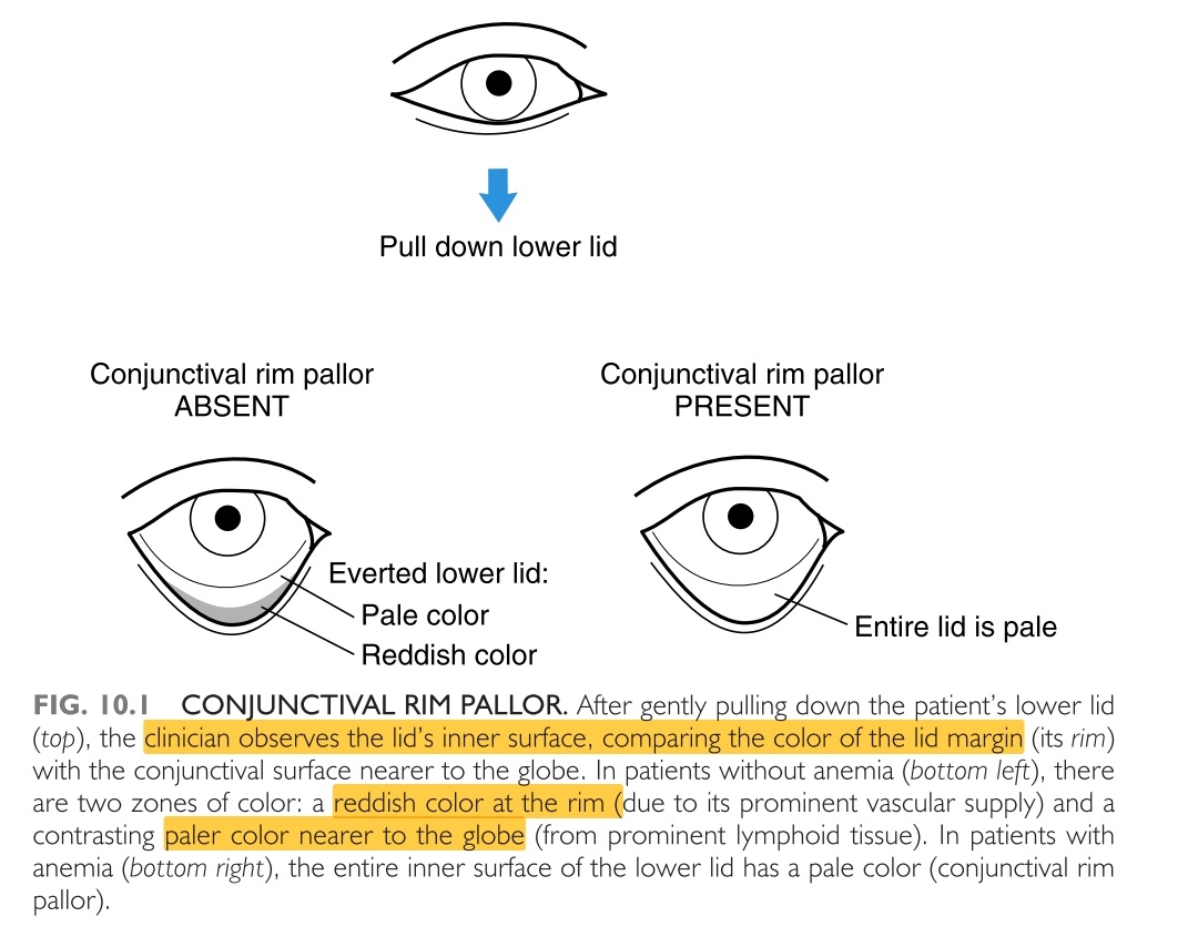 Pallor Conjunctiva