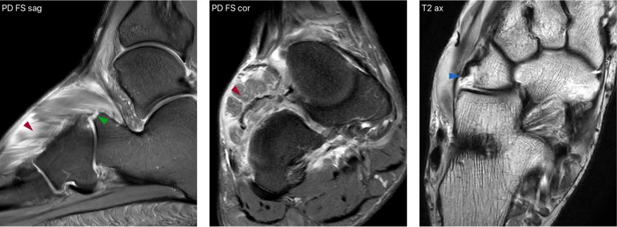 Extensor Digitorum Brevis Mri