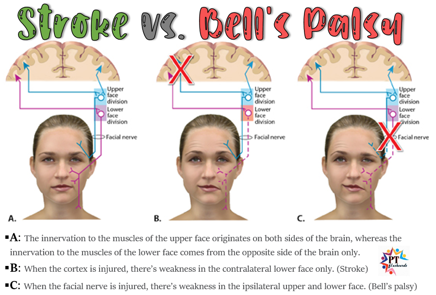 Bells Palsy Deutsch : Bell S Palsy Auf Deutsch Deutsch Ubersetzung ... Bells Palsy Deutsch : Bell S Palsy Auf Deutsch Deutsch Ubersetzung ...