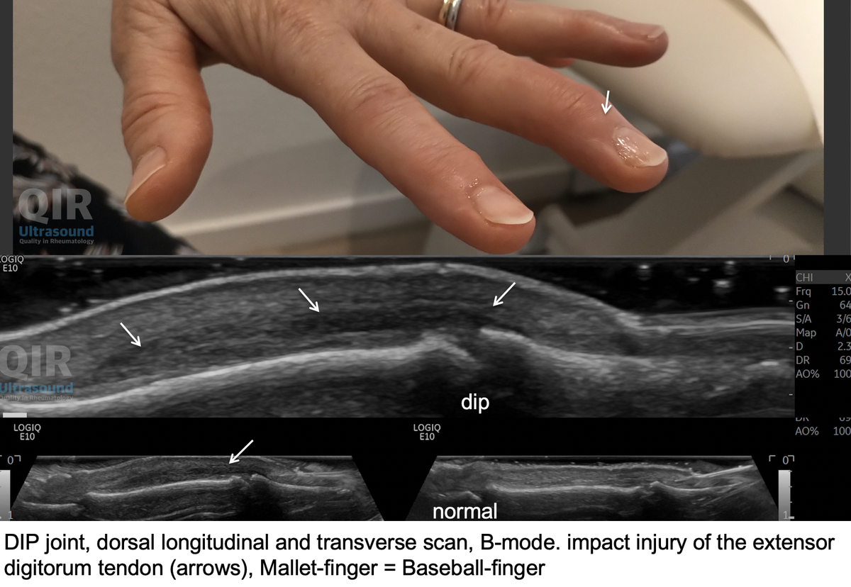 Finger Extensor Tendons Ultrasound