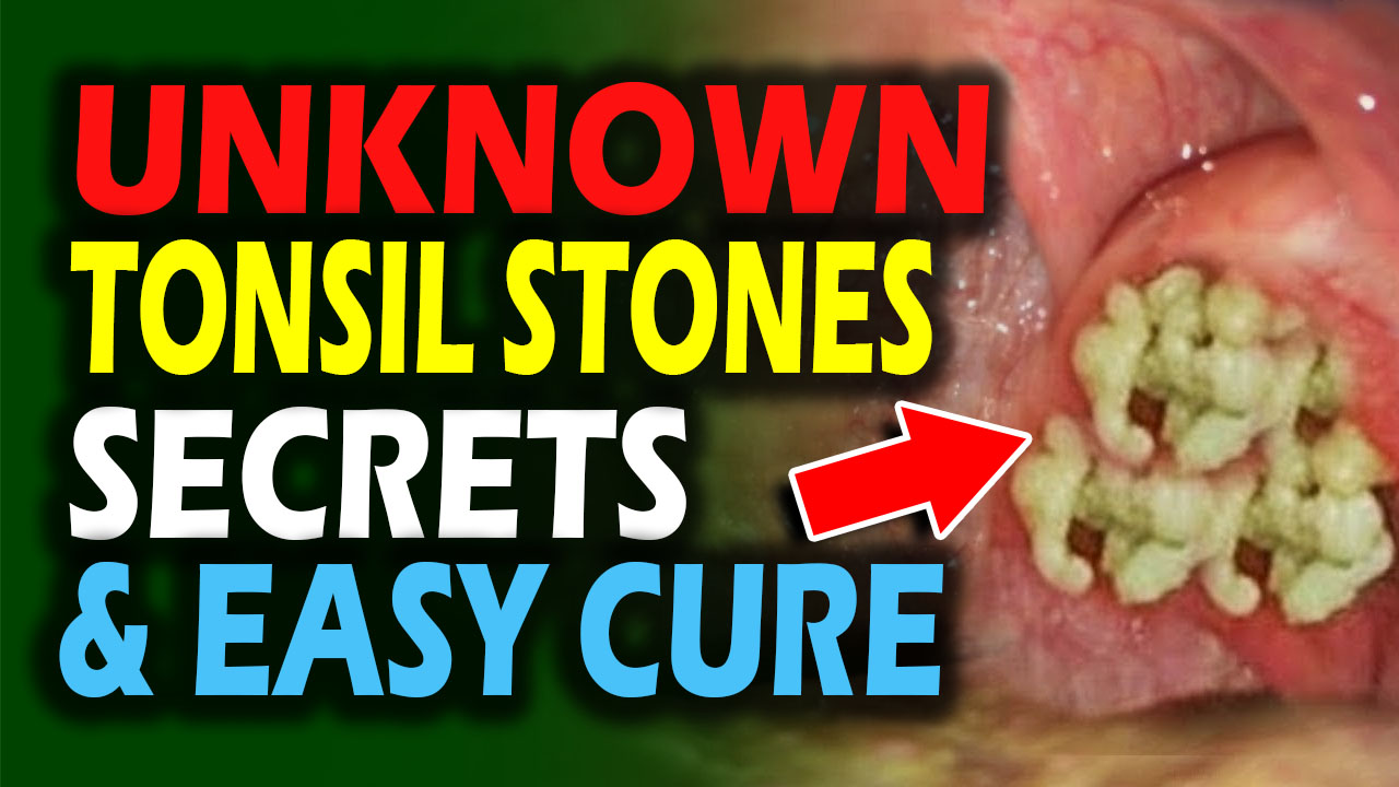 How To Cure Tonsils Stones