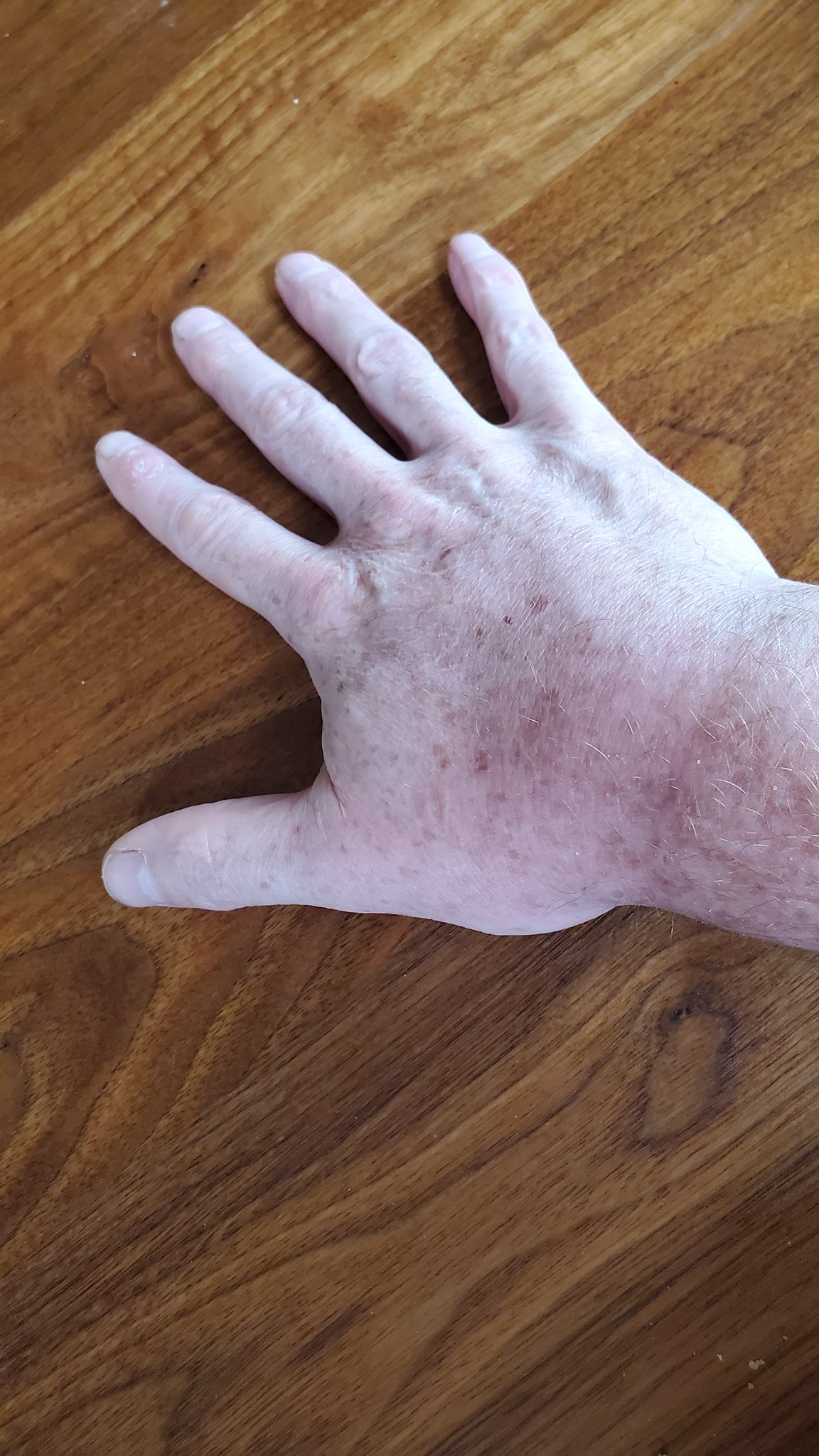 Wasp Sting Hand