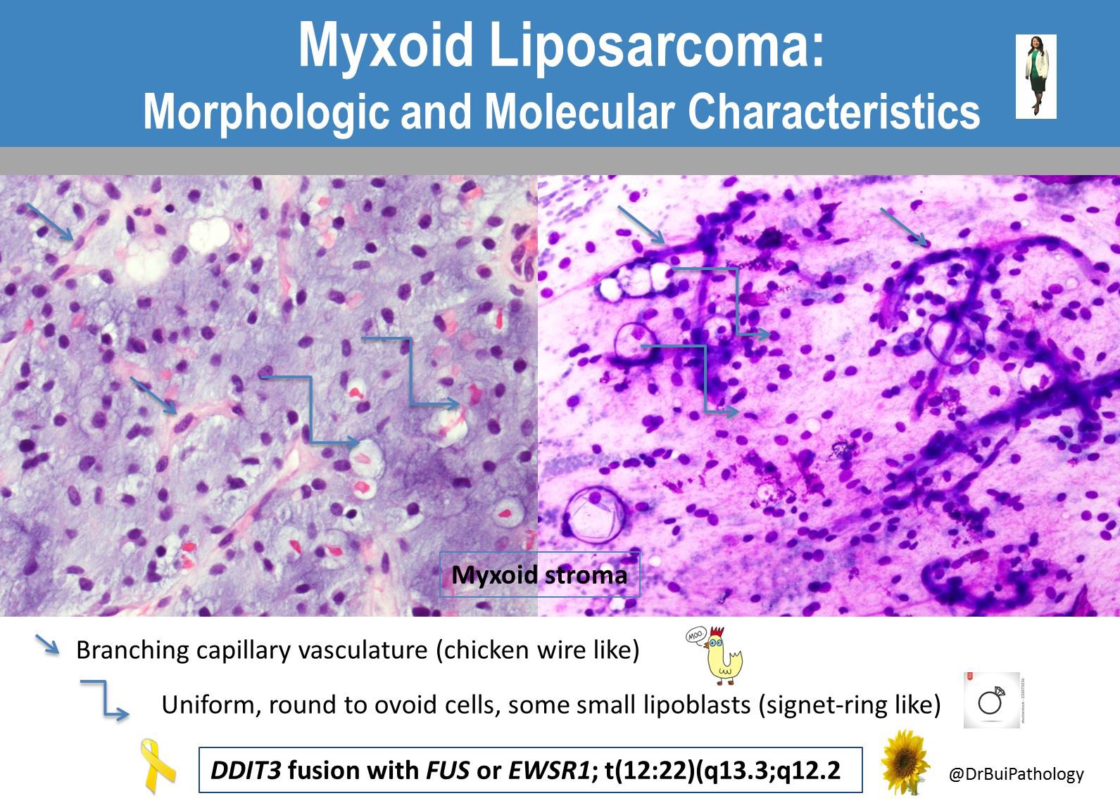 Liposarcoma Pathology Outlines Kaposi Sarcoma (vascular Tumor