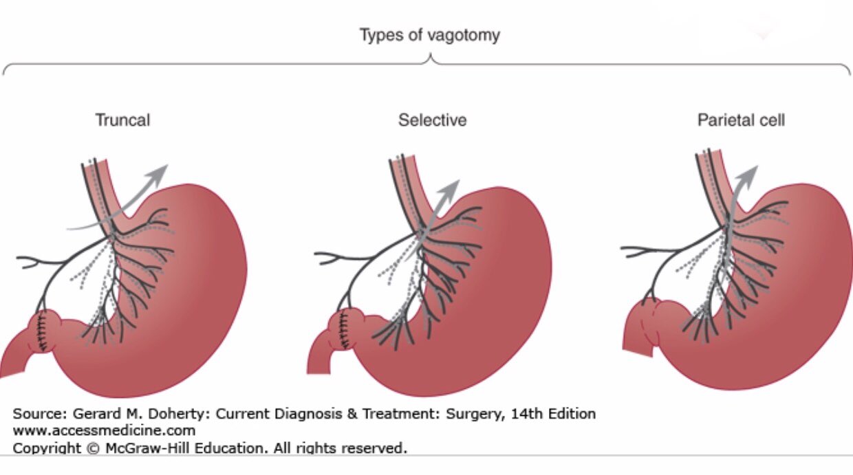 Truncal Vagotomy Open