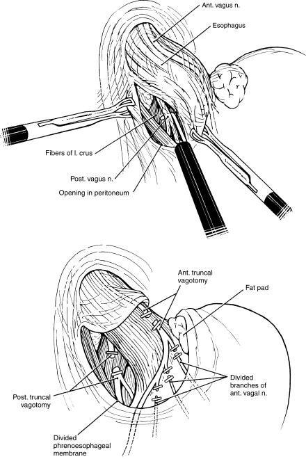 Truncal Vagotomy Open