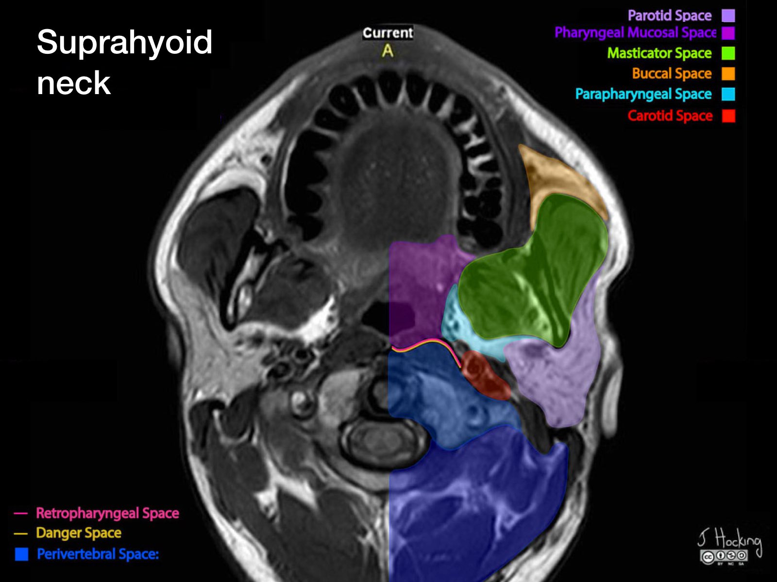Neck Spaces Ct Anatomy NECK SPACES AND ANATOMY Ppt Download