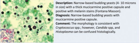 Cryptococcus Neoformans Mucicarmine Stain