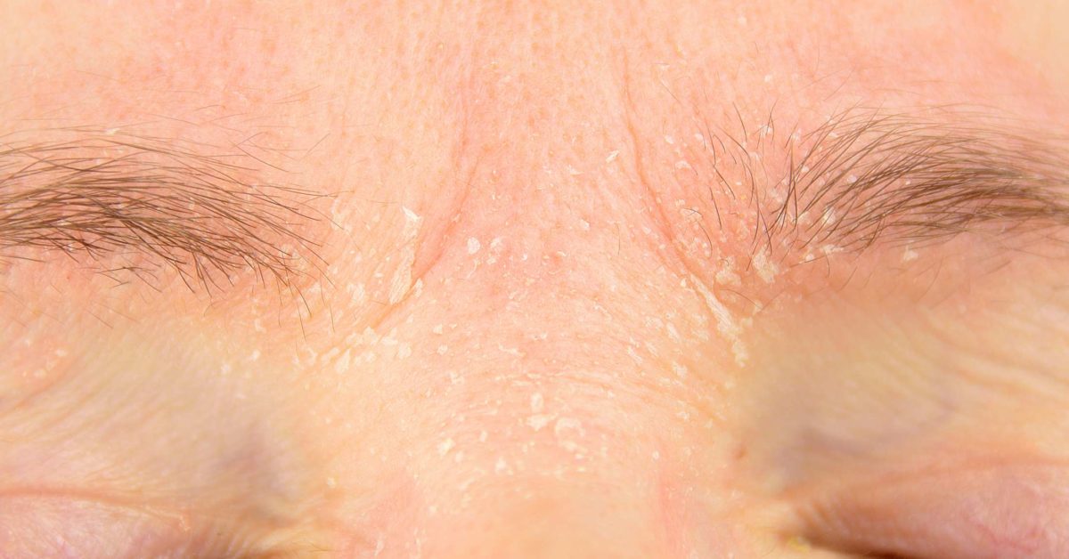 Psoriasis Eyelid