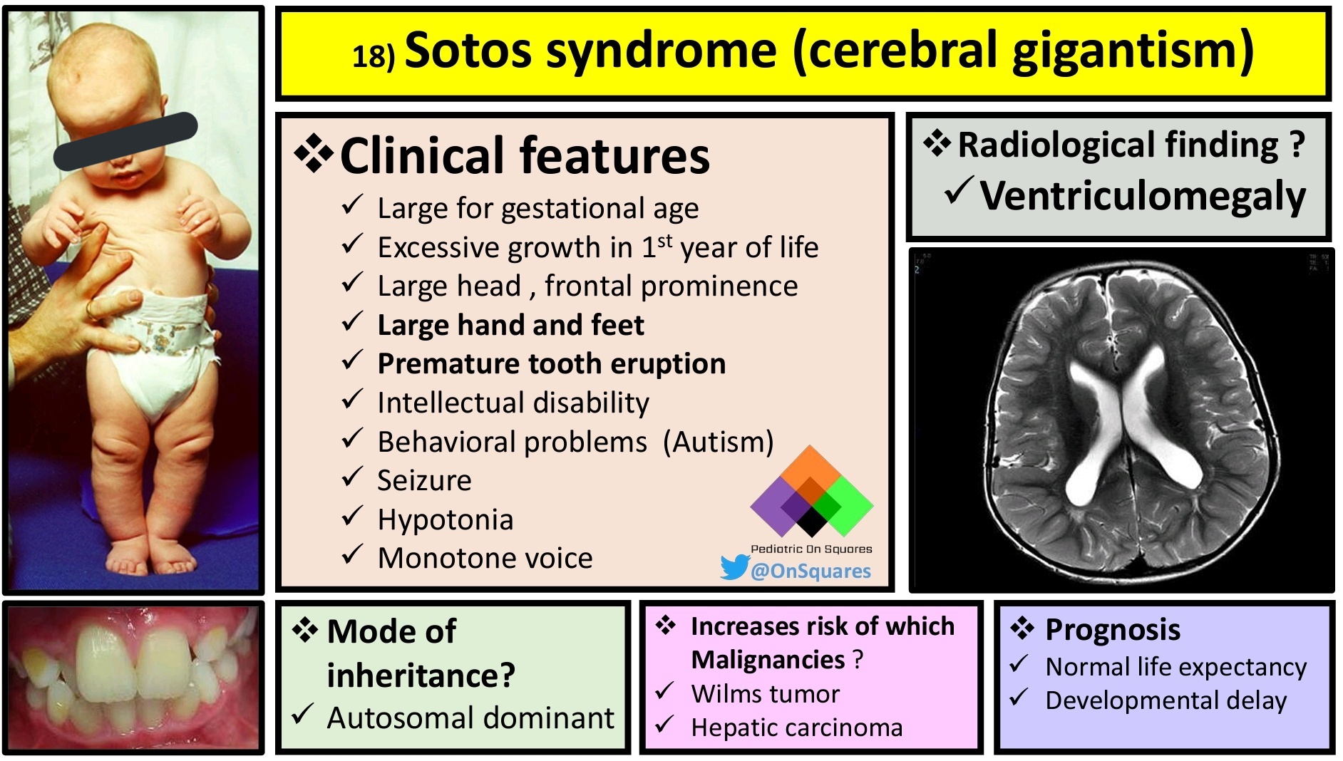Soto Syndrome Life Expectancy Cardiovascular Concerns, Cancer