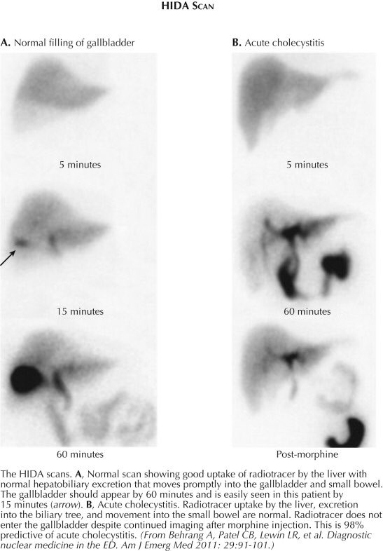 Acalculous Cholecystitis Hida