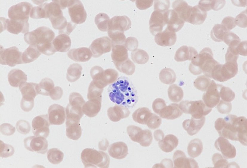Histoplasmosis In Blood