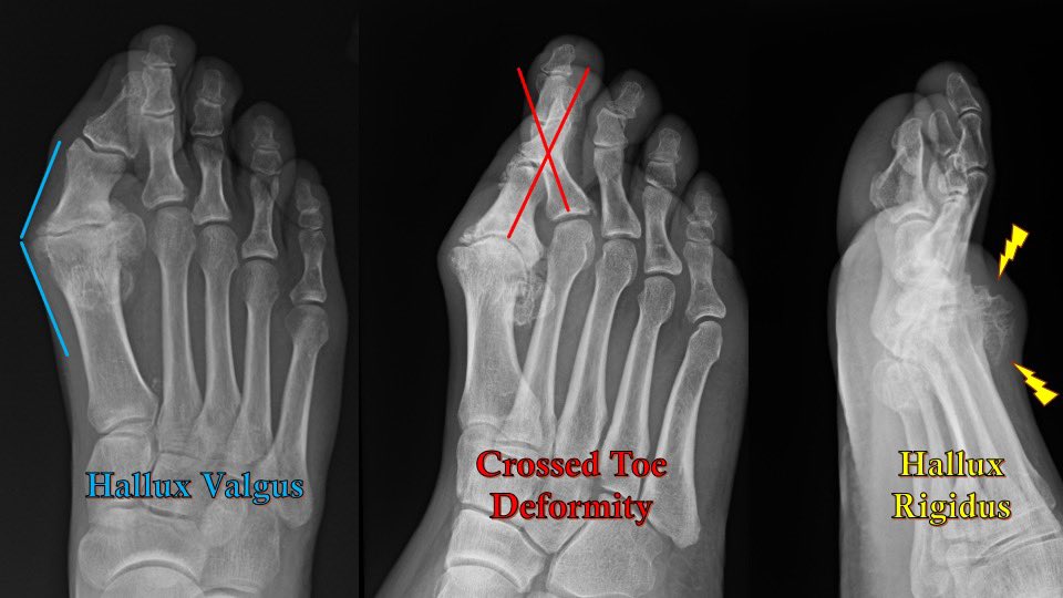 Hallux Rigidus X Ray