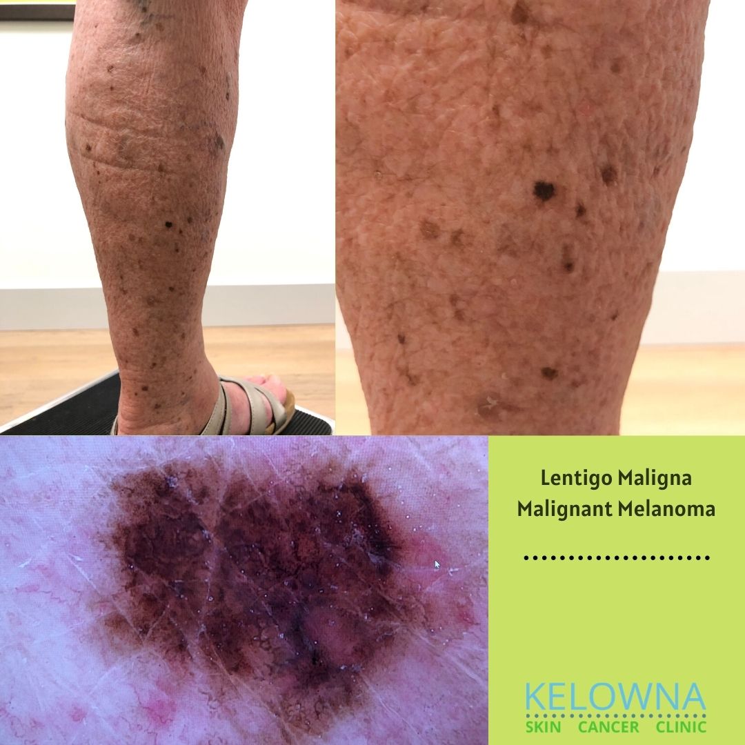 Lentigo Maligna Melanoma Foot