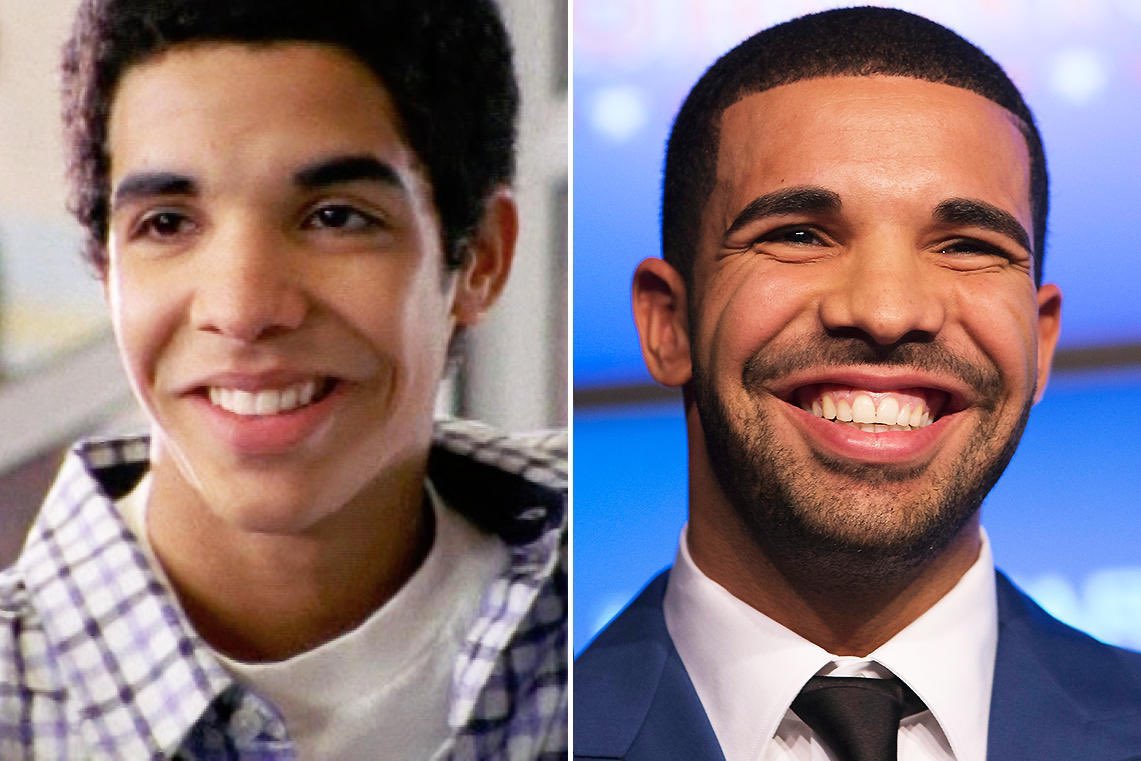 Drake Nose Job