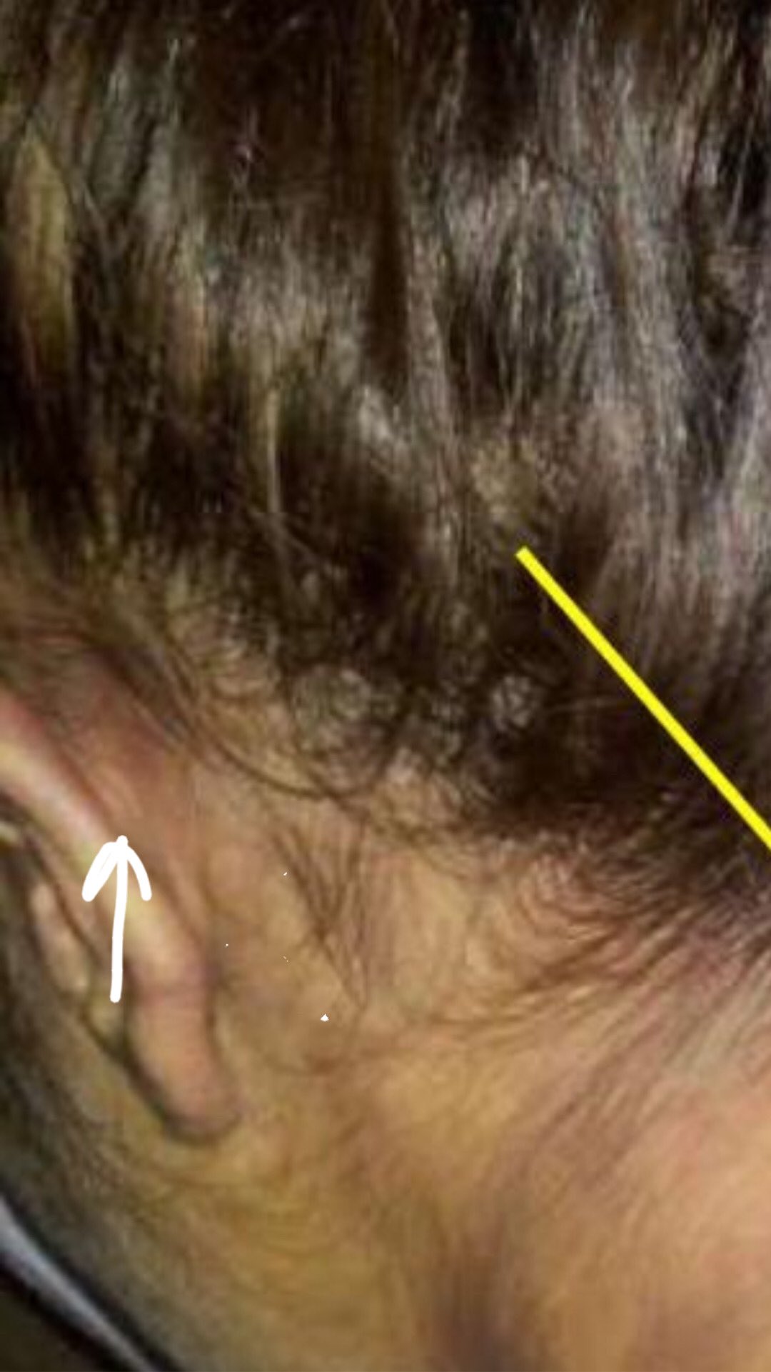 Swollen Posterior Auricular Lymph Node