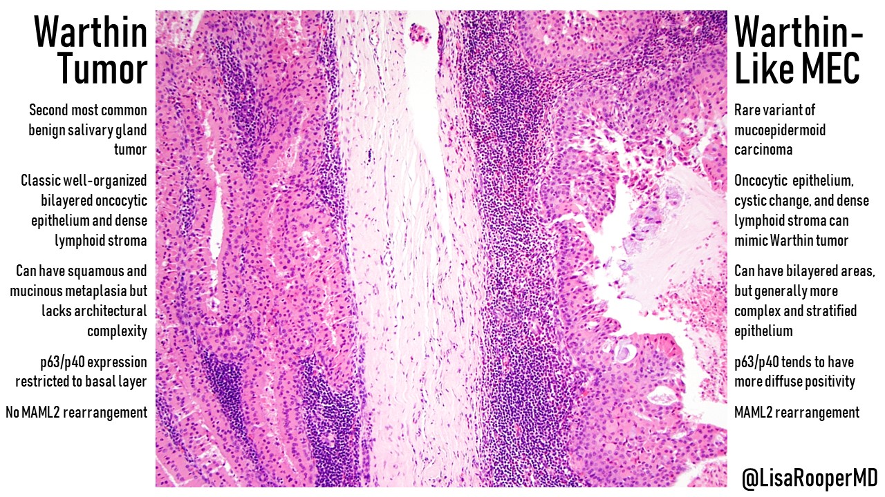 Mucoepidermoid Carcinoma