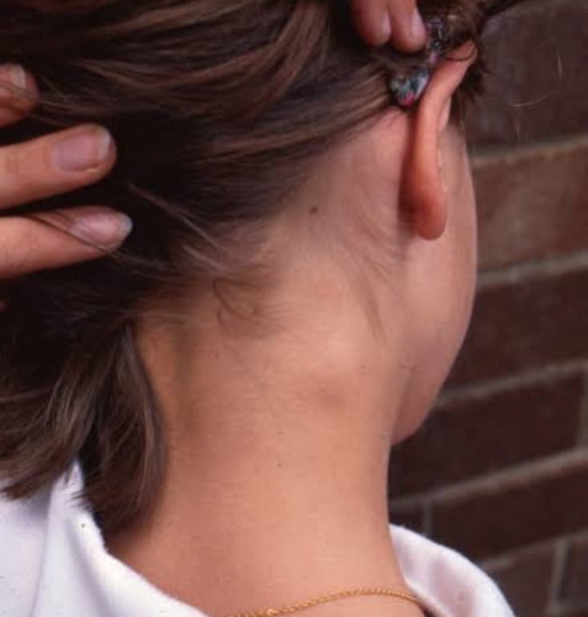 Cat Scratch Disease Neck