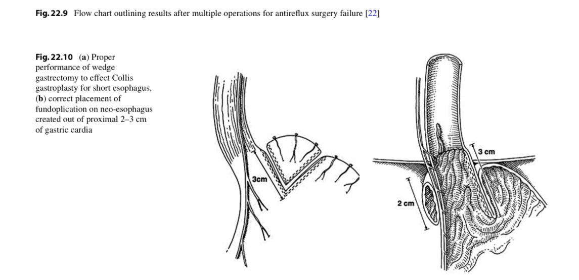 Collis Gastroplasty