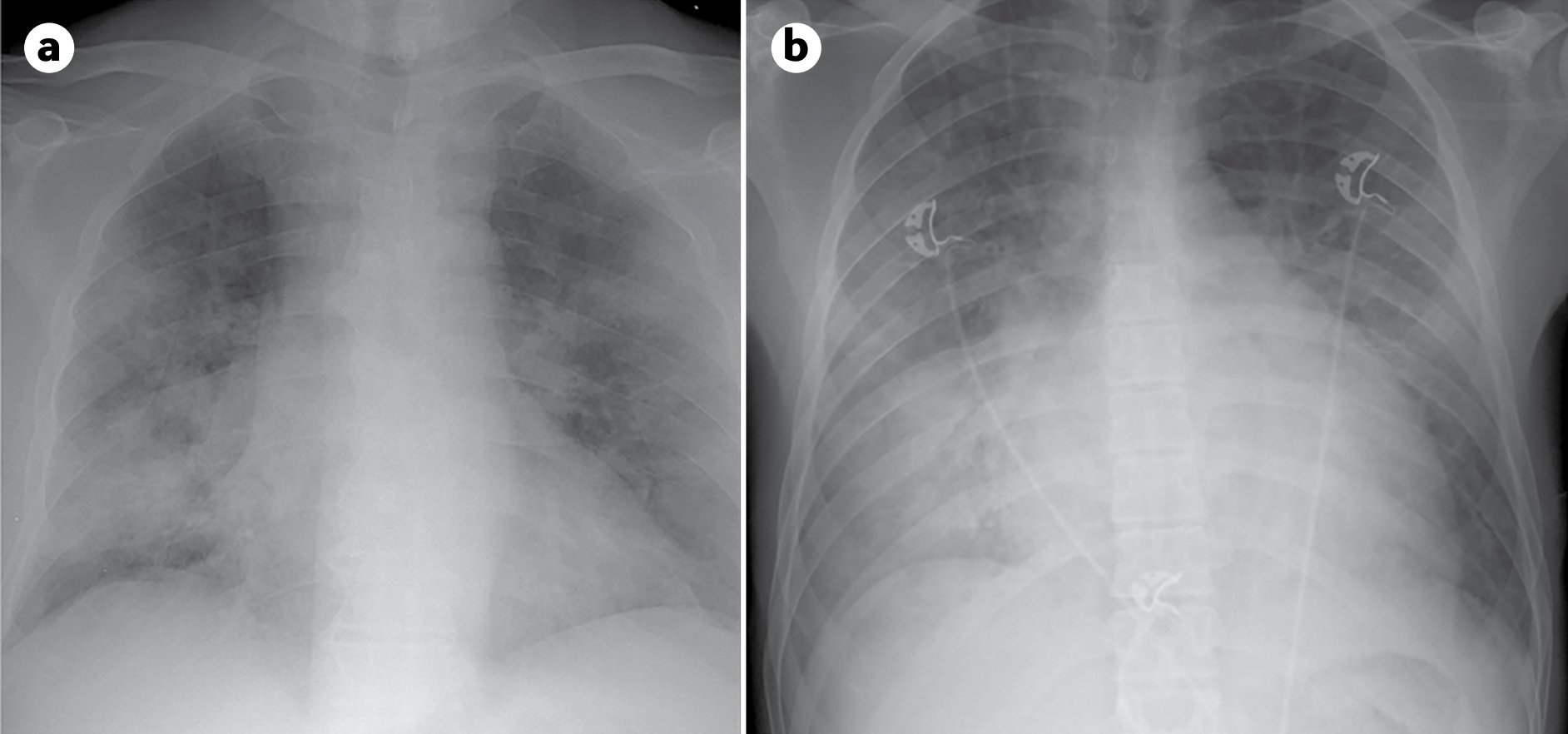 Radiografía De Edema Pulmonar