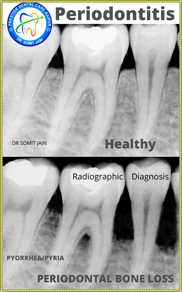 Periodontal Disease Xray