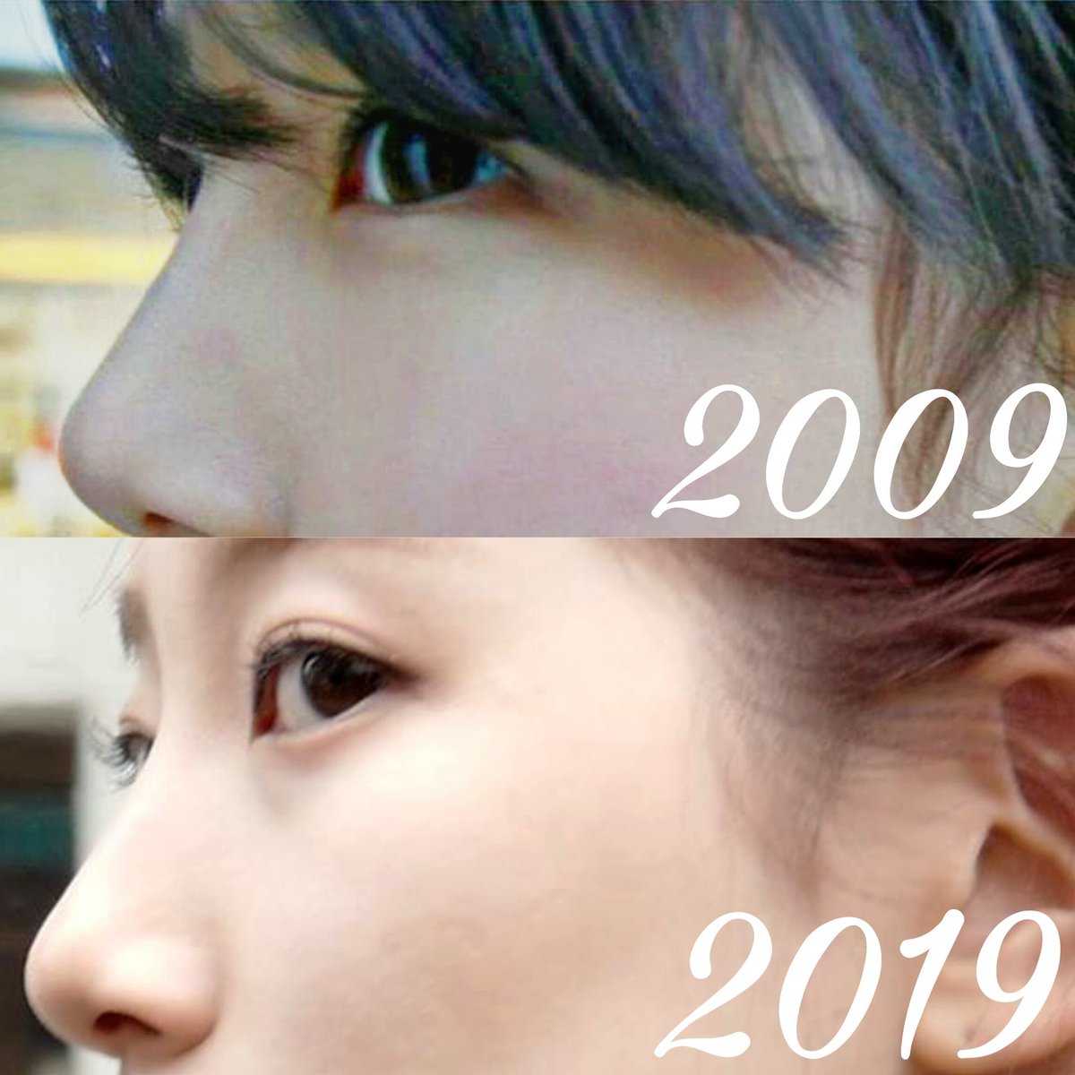 Suzy Plastic Surgery