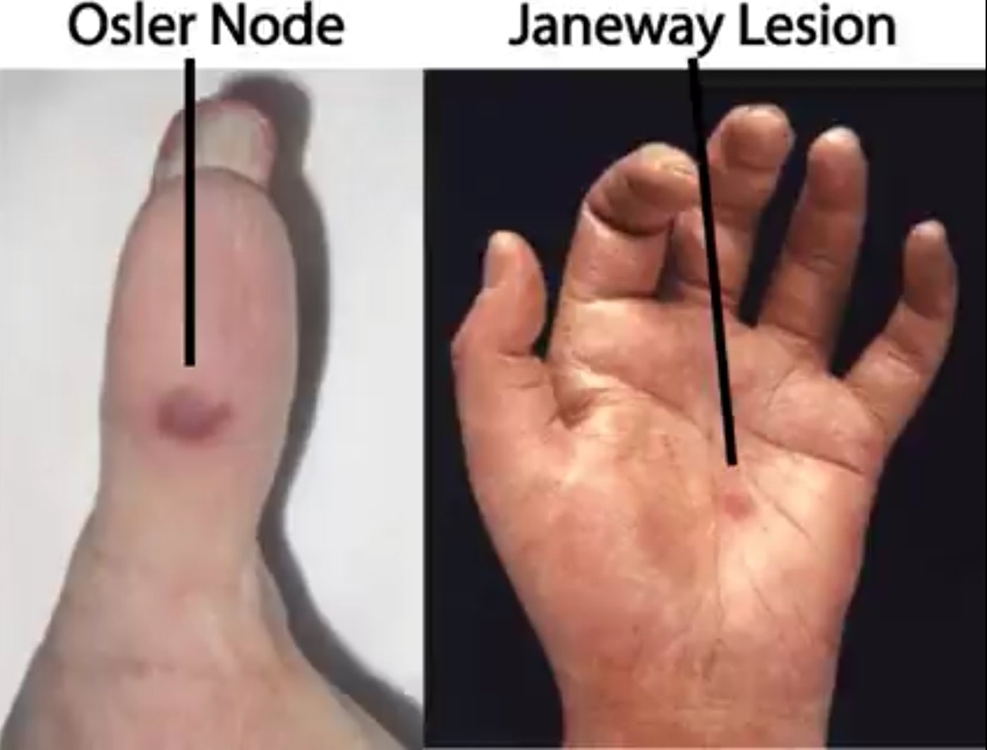 Janeway Lesions