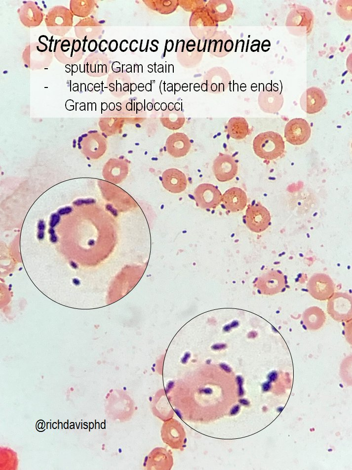 Streptococcus Pneumoniae Capsule Stain