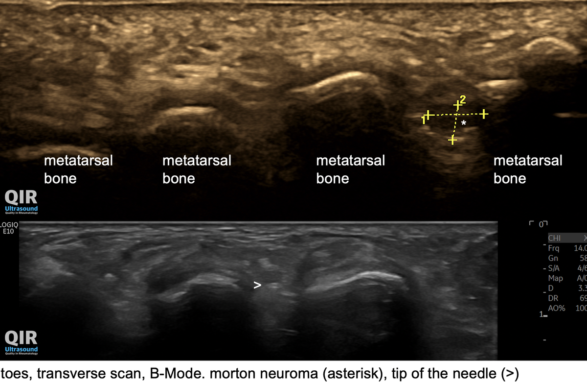 Foot Neuroma Ultrasound