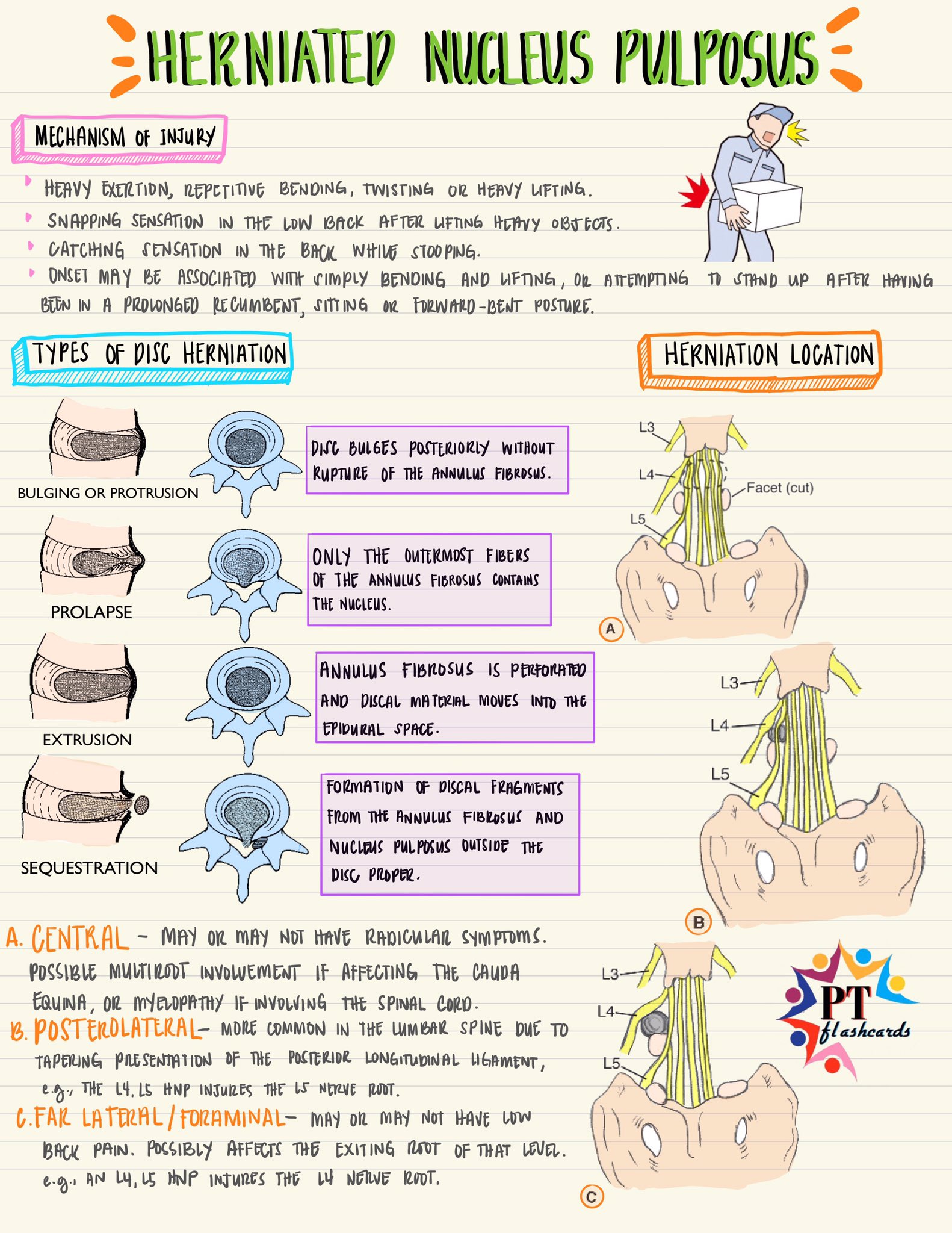 PT flashcards on Twitter: "Herniated Nucleus Pulposus (HNP) References: Cuccurullo, Sara ...
