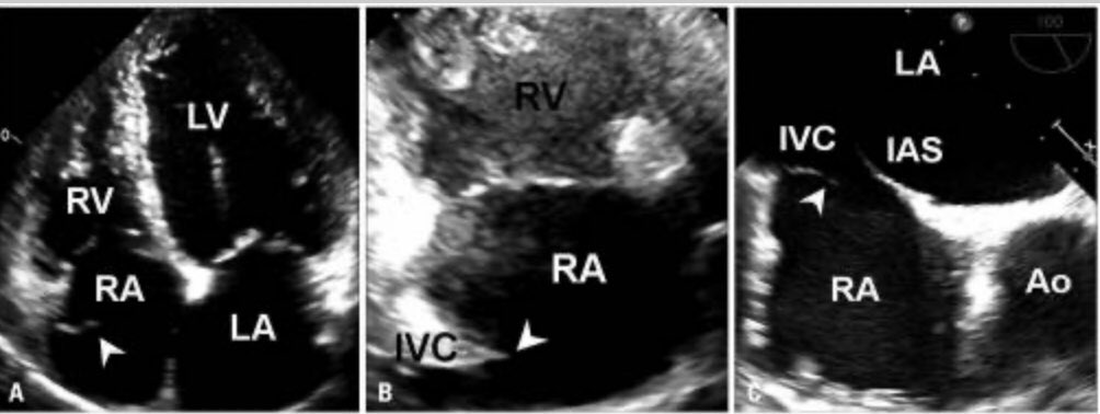 #EchoBoardPrep #ACCFIT Anatomic Variants But 1st, RA anatomy: ⚡ ...