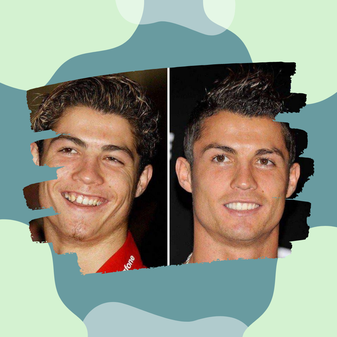 Cristiano Ronaldo Before And After Plastic Surgery
