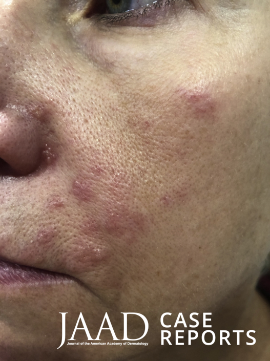 Herpes Zoster On Nose