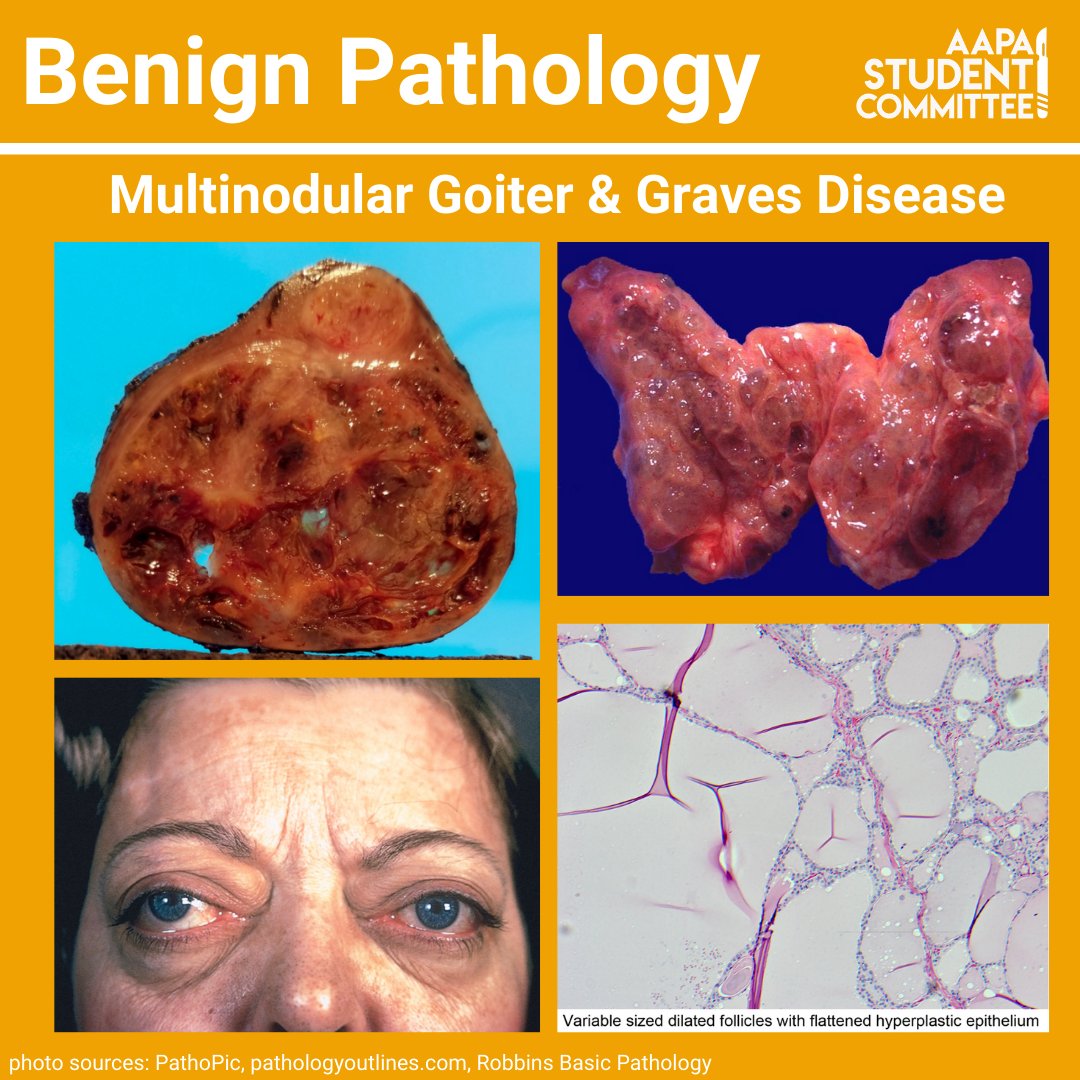 Multinodular Goiter Gross