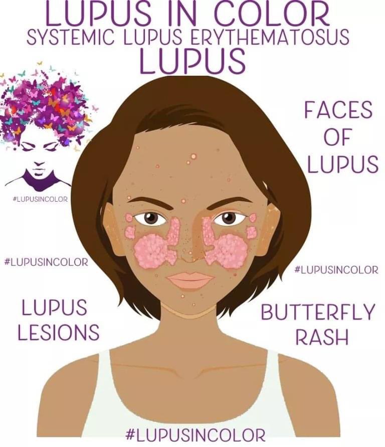 Lupus In Color On Twitter A Main Face Of Lupus Is That Of Lupus Lesions And Butterfly Rashes