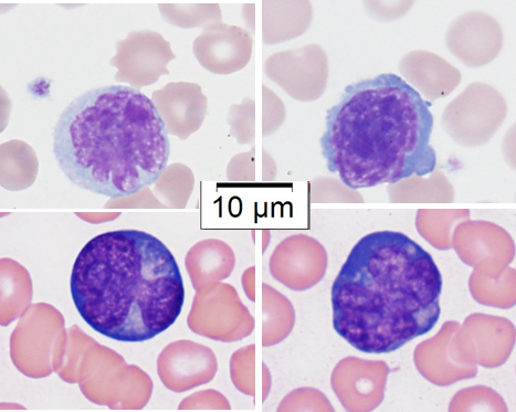 Reactive Lymphocytes Lymphocytes And Reactive Lymphocytes