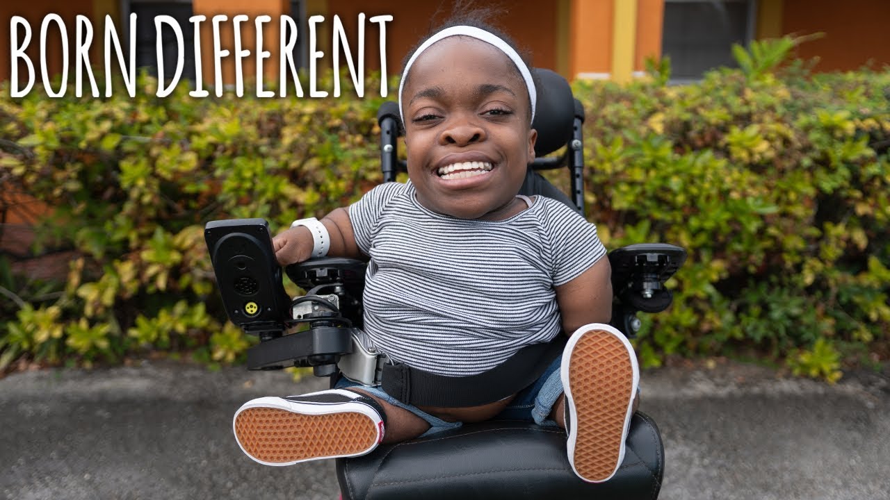 Achondroplasia Toddler