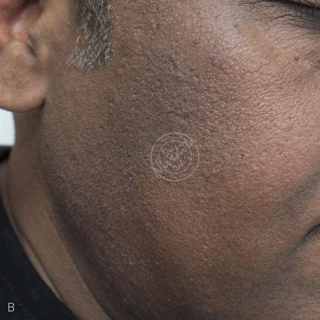 Acanthosis Nigricans Forehead