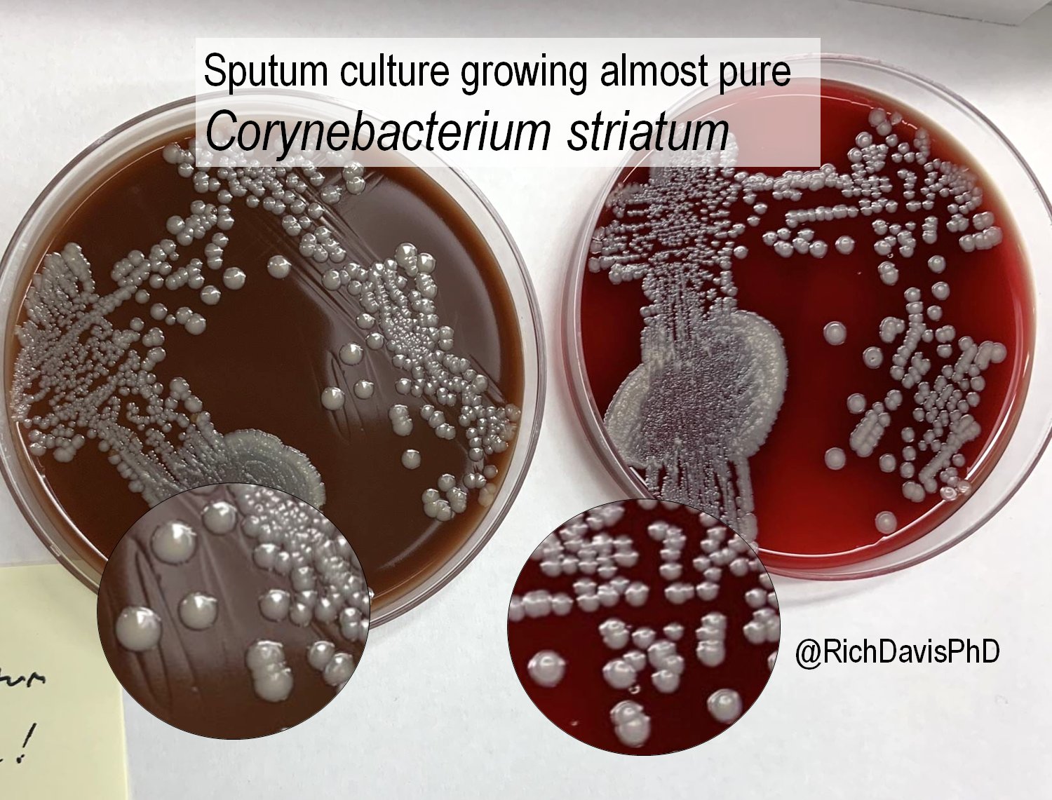 Pneumonia Sputum Culture
