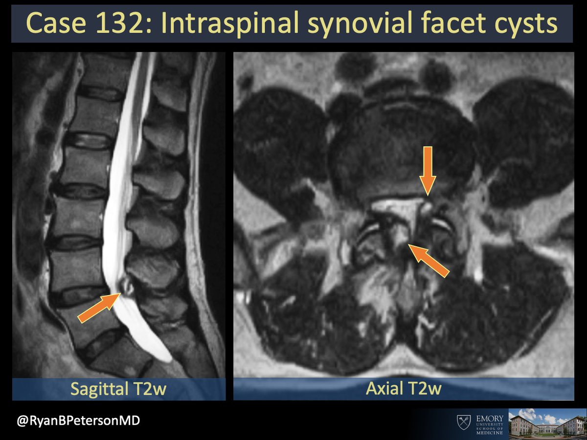 Emory Radiology COTD #132 Hx: Back pain & radiculopathy NO SPOILERS or ...