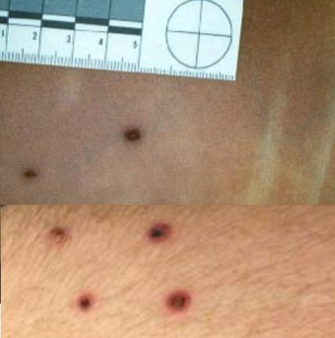 Taser Marks On Chest