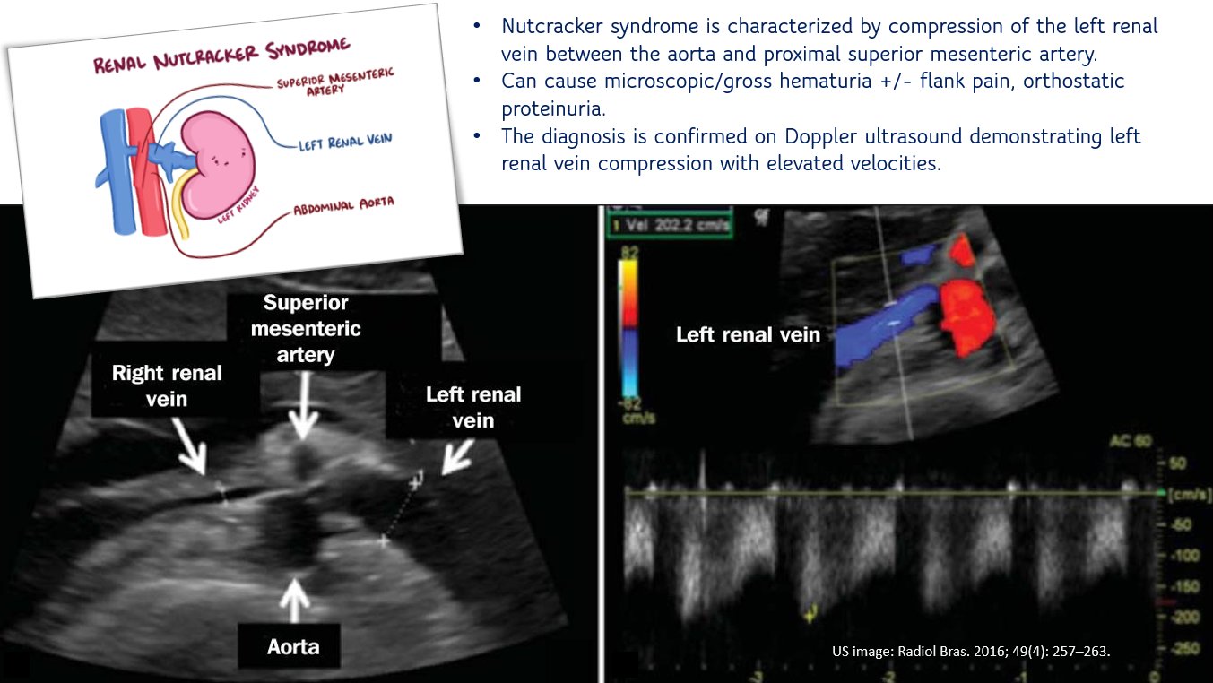 Nutcracker Syndrome Ultrasound
