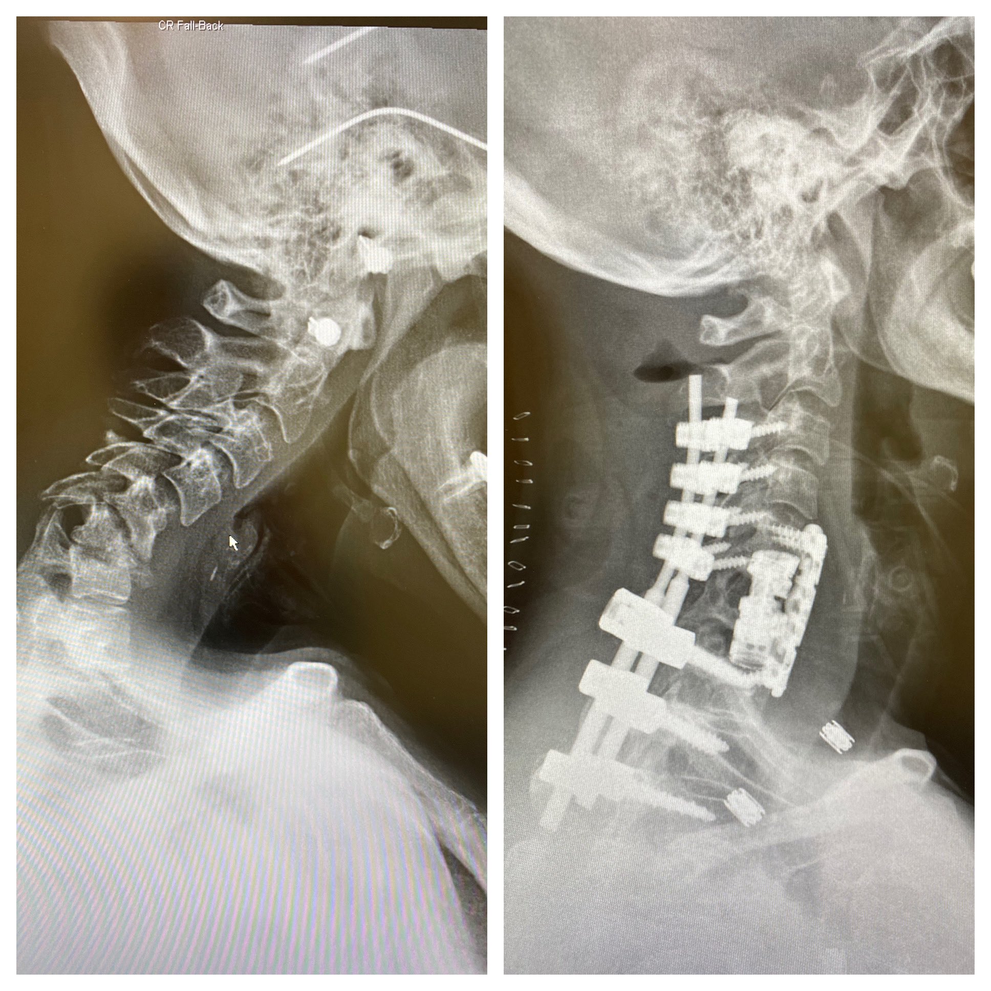 Severe Cervical Kyphosis