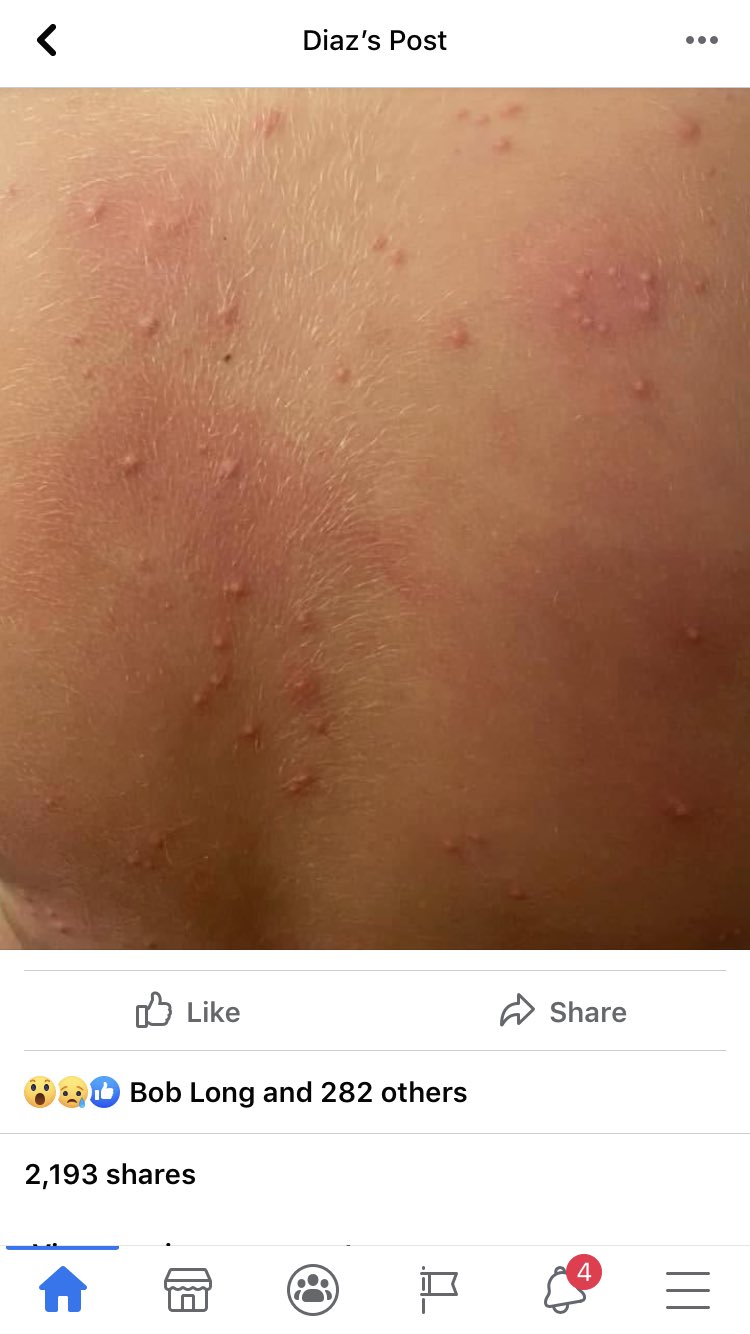 Sea Lice Bites On Humans