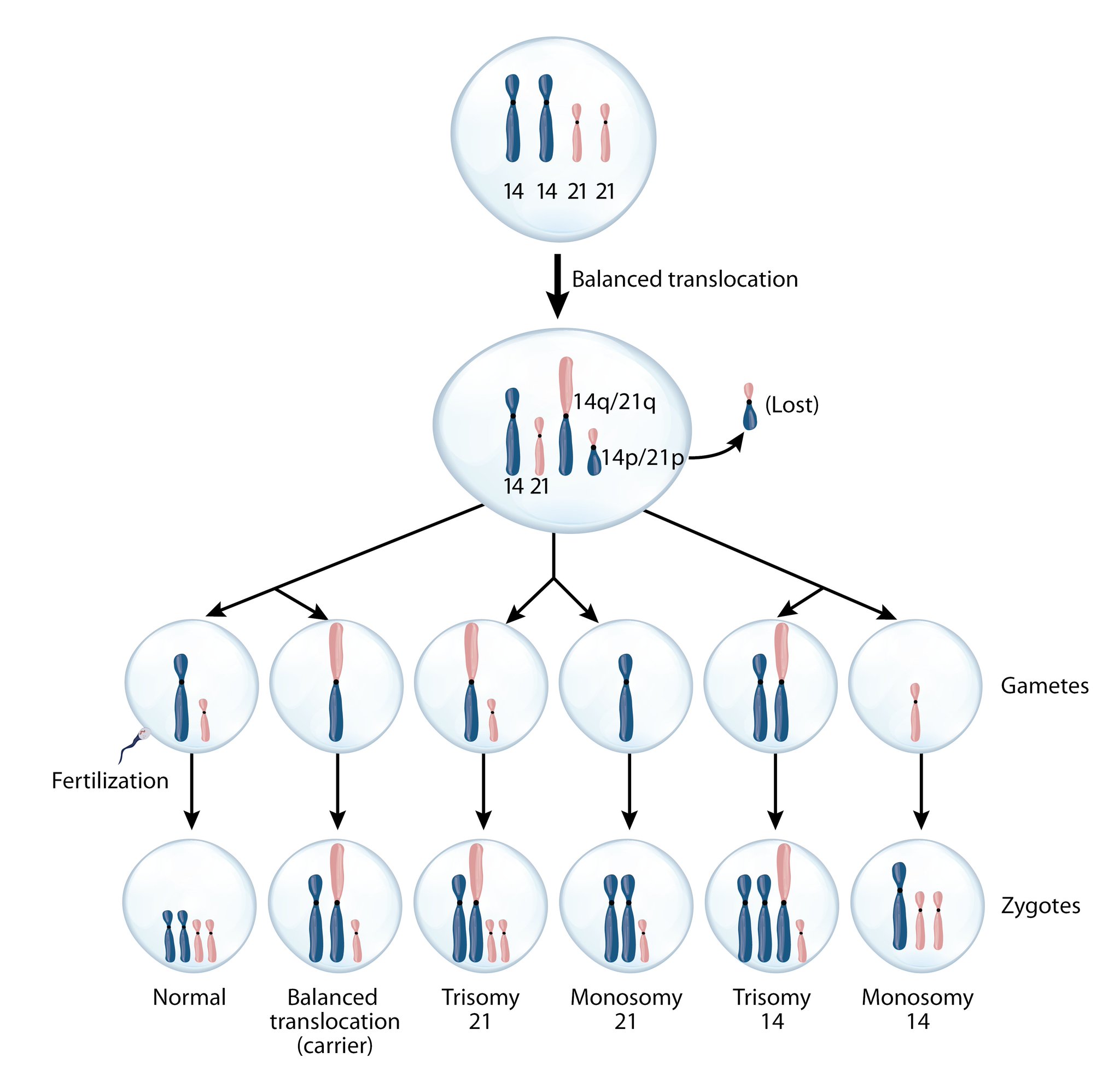 Translocation Mutation Down Syndrome