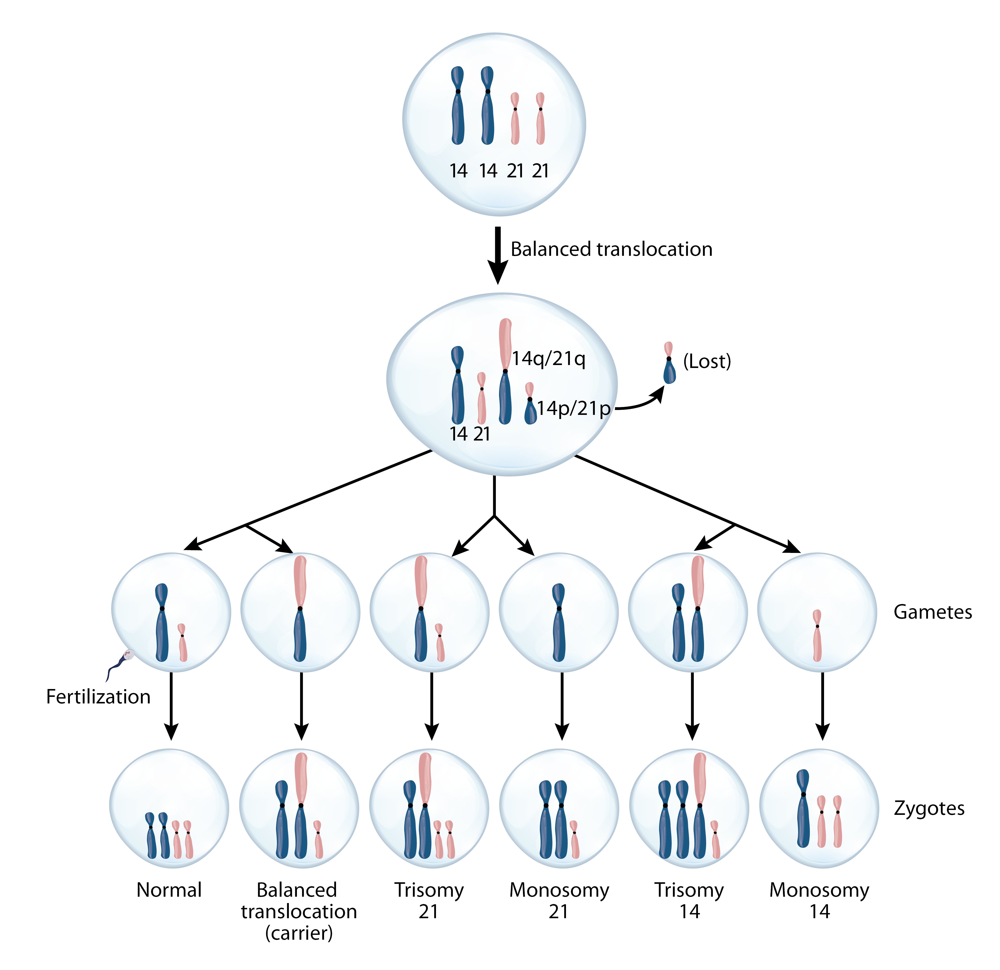 Translocation Down Syndrome Diagram