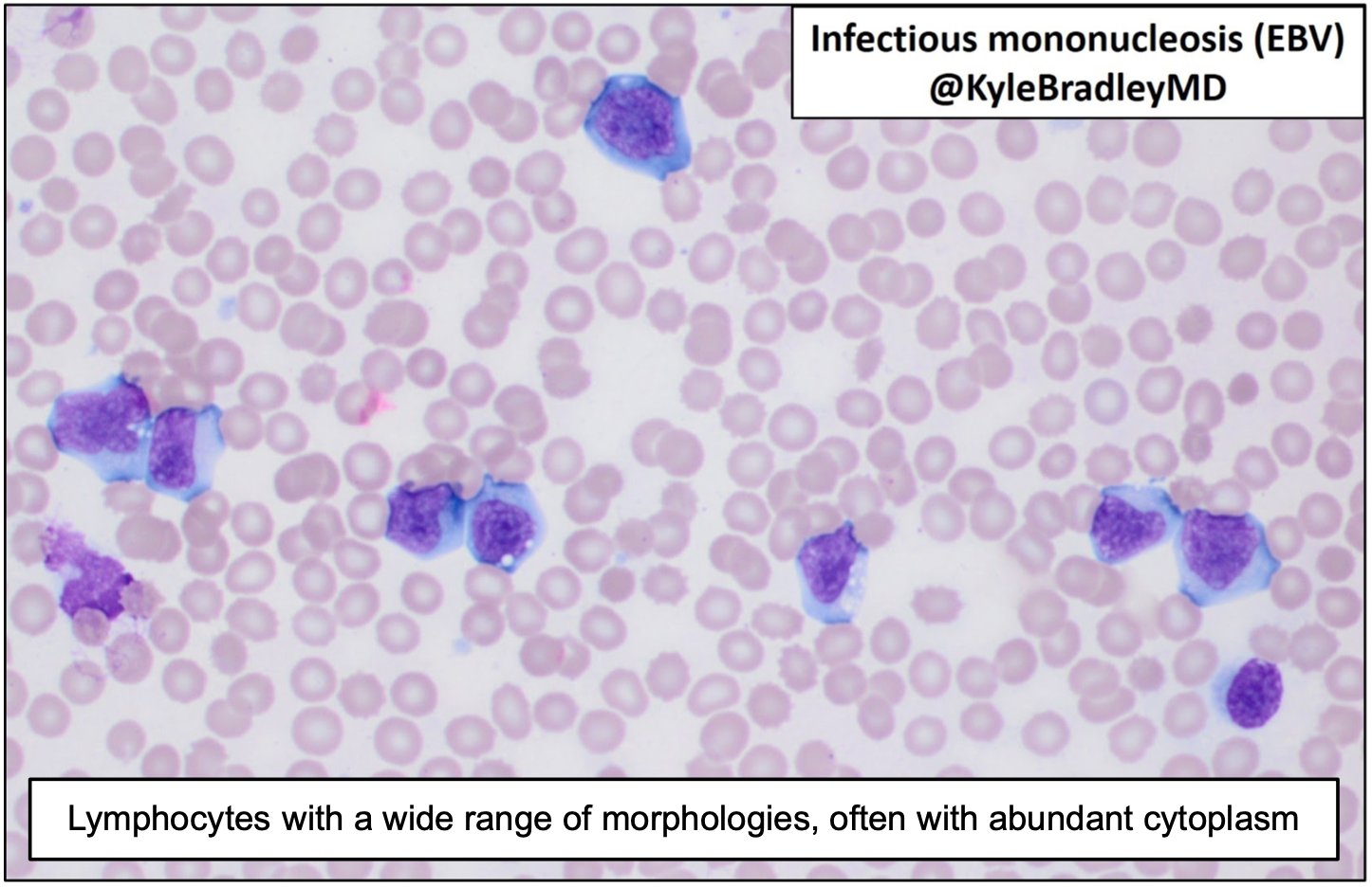 Infectious Mononucleosis Blood Smear