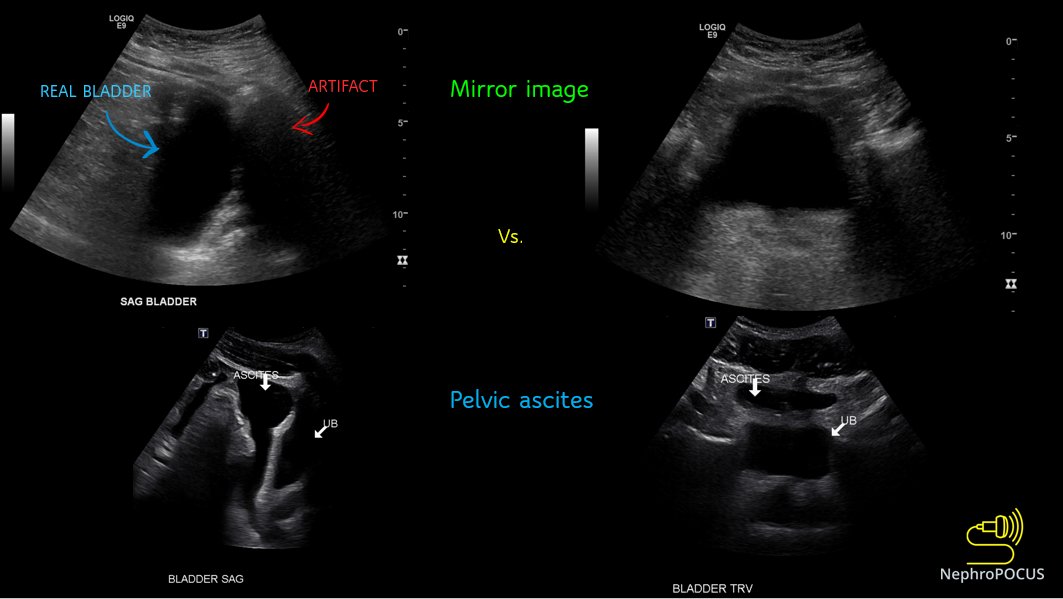Ascites Ultrasound