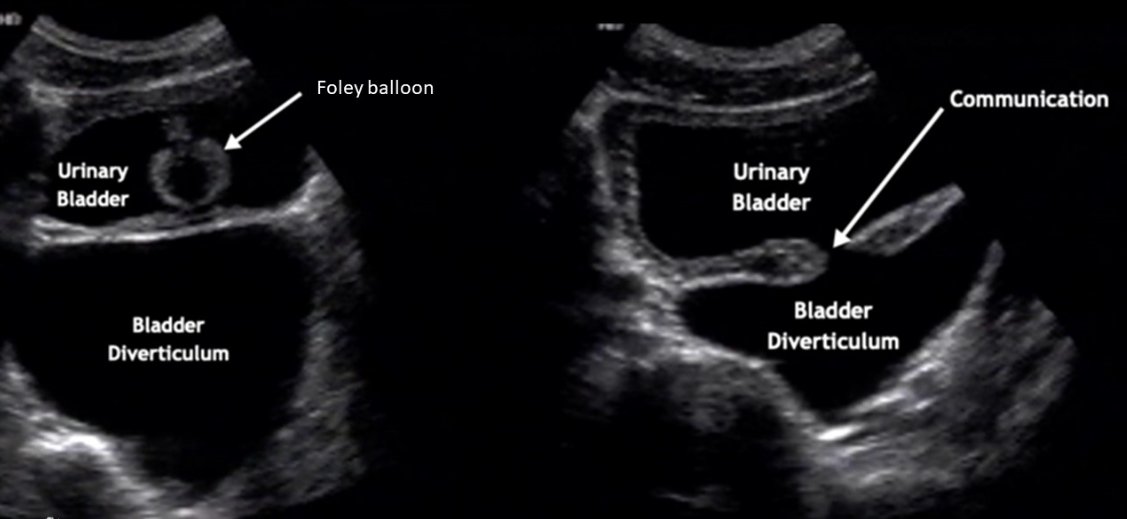 Bladder Diverticulum Ultrasound